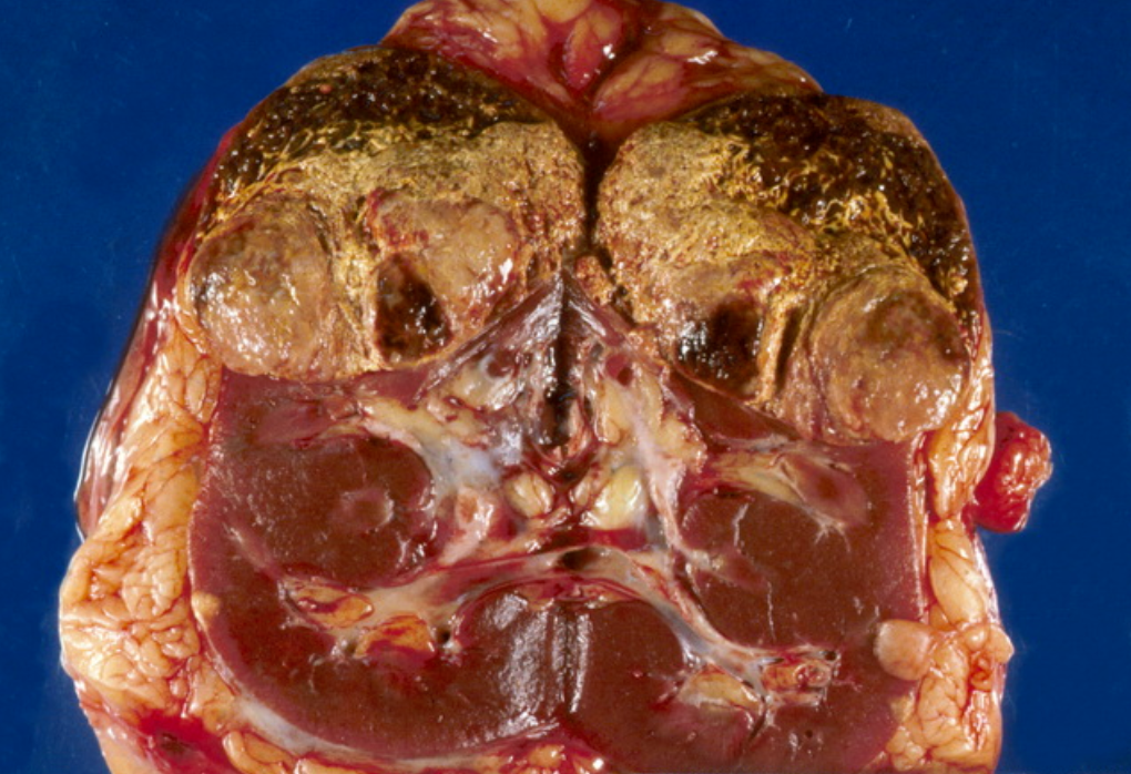 Renal | Pathology Images Flashcards | Memorang