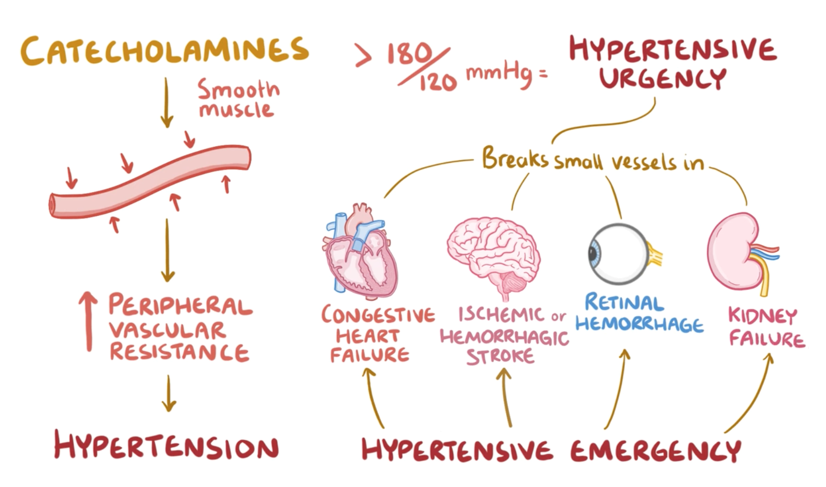 Pheochromocytoma Flashcards | Memorang