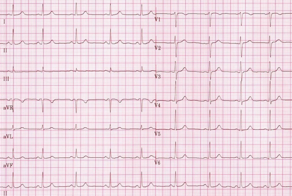 Visual Diagnosis: EKGs Flashcards | Memorang