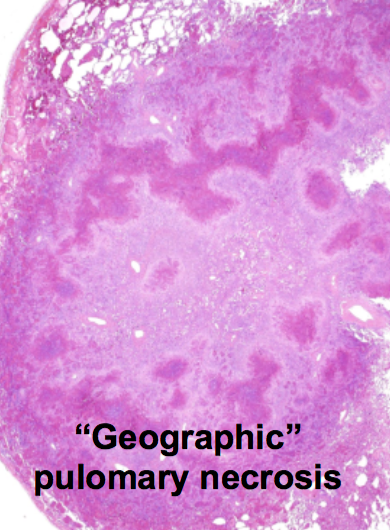 Vasculitis Flashcards Memorang