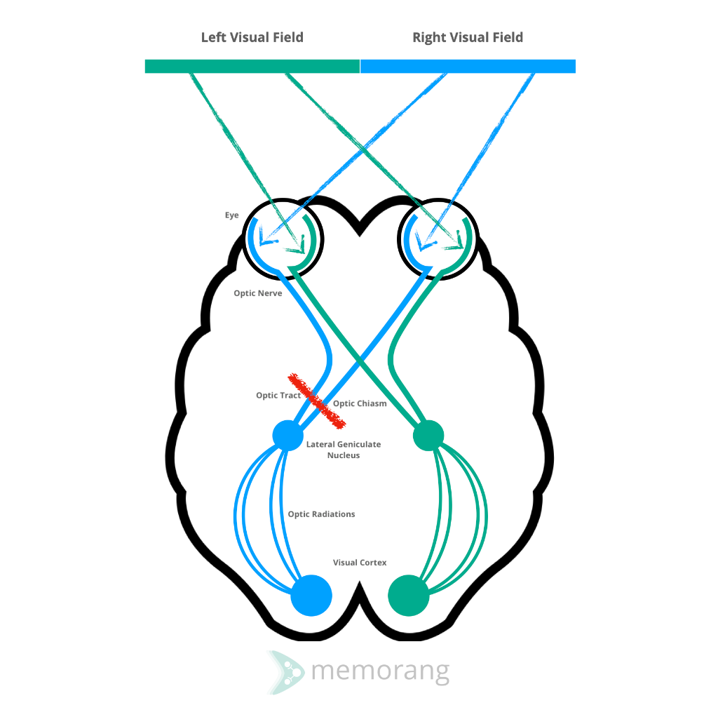 Visual Field Defects Flashcards | Memorang