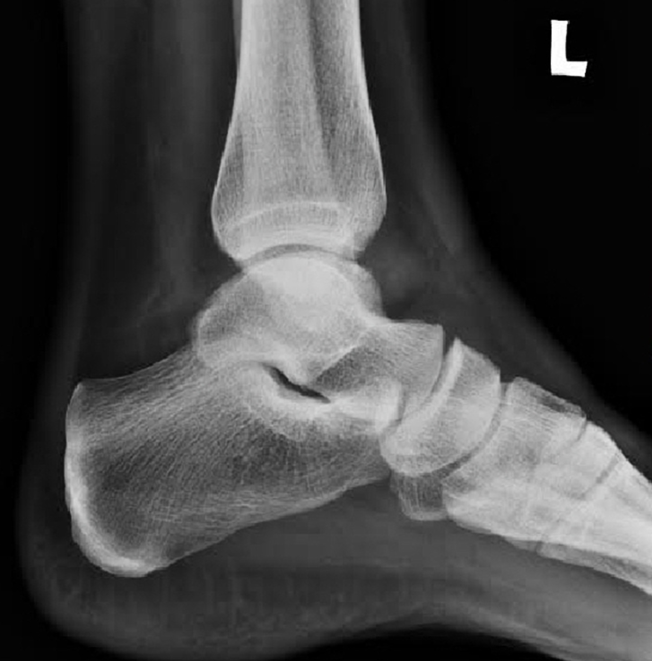 Foot and Ankle Pathology Flashcards | Memorang Foot and Ankle Pathology Flashcards | Memorang
