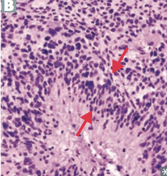 Rod Shaped Blepharoplast Ependymoma