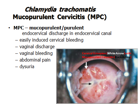Mucopurulent Discharge