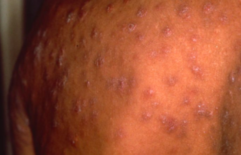 STIs Flashcards | Memorang