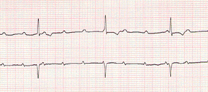 Arrhythmias Flashcards | Memorang