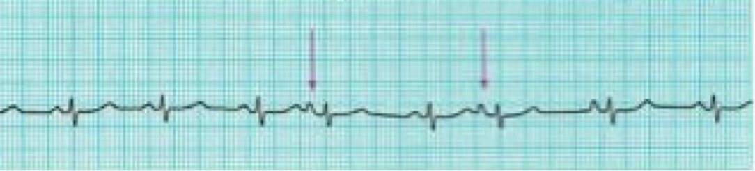 ECG Flashcards | Memorang