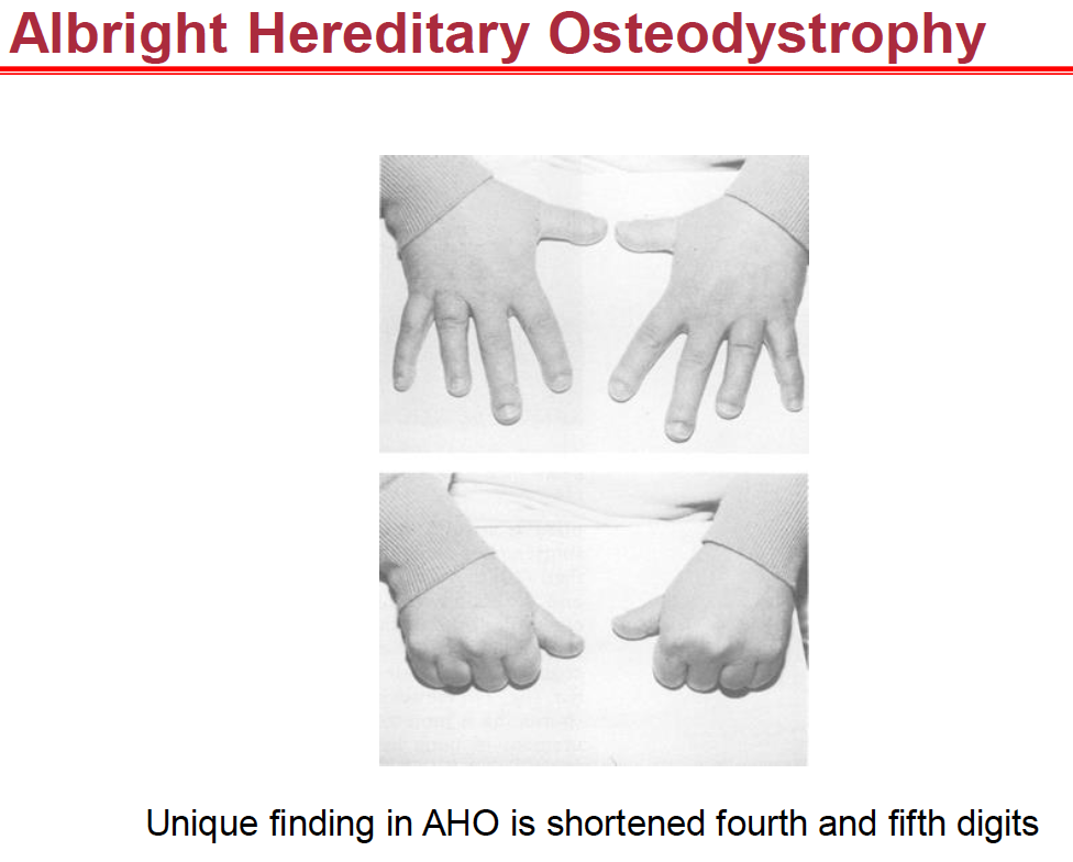 Albright Hereditary Osteodystrophy