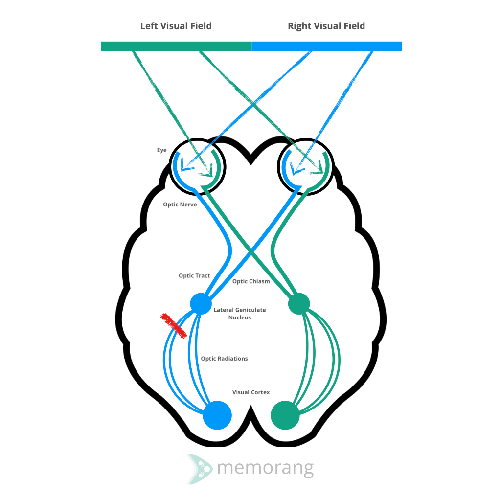 Visual Field Defects Flashcards | Memorang