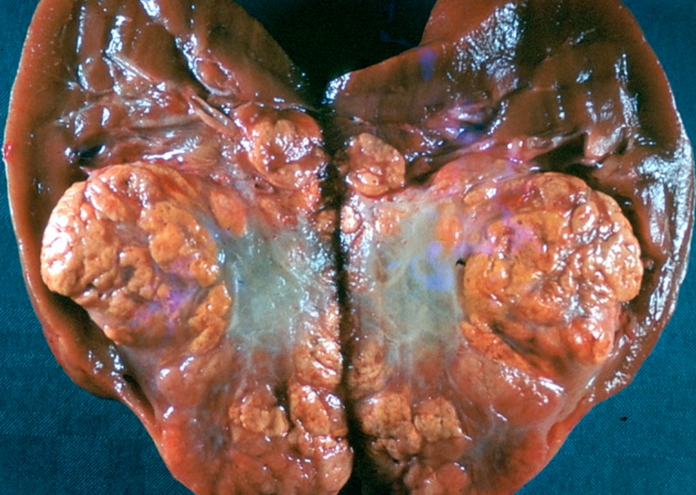 Renal | Pathology Images Flashcards | Memorang