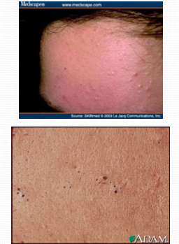 Dermatoses Flashcards | Memorang