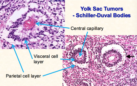 Yolk Sac Tumor Schiller Duval Bodies