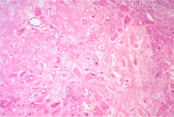 Pathology Flashcards | Memorang