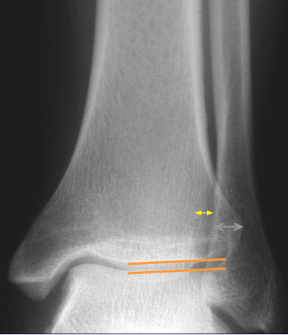 Ankle Imaging Flashcards | Memorang