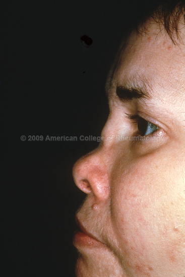 Saddle Nose Syphilis Baby