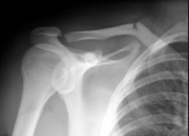 Shoulder Pathology Flashcards | Memorang